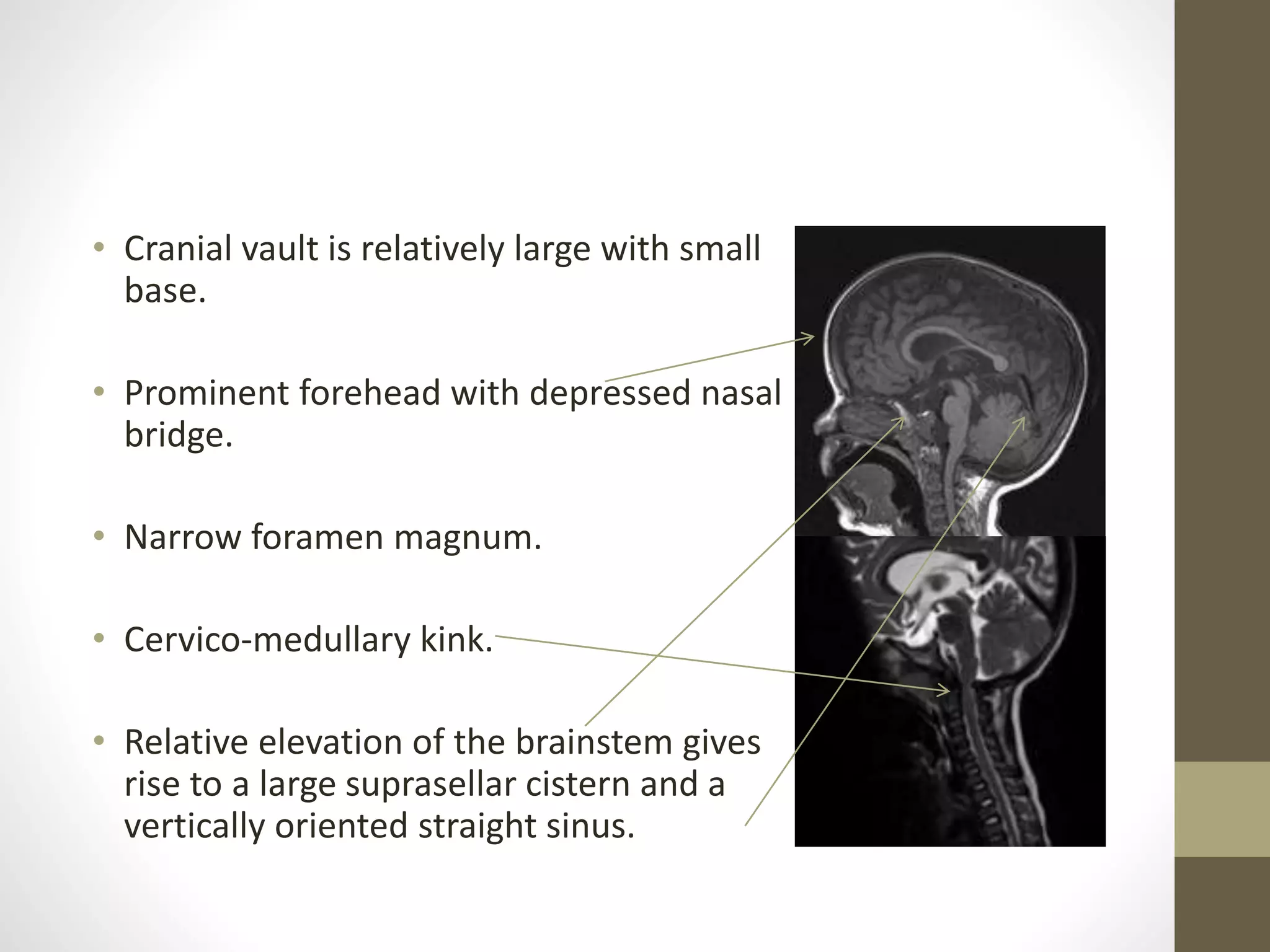Achondroplasia, pseudochondroplasia & hypochondroplasia | PPTX