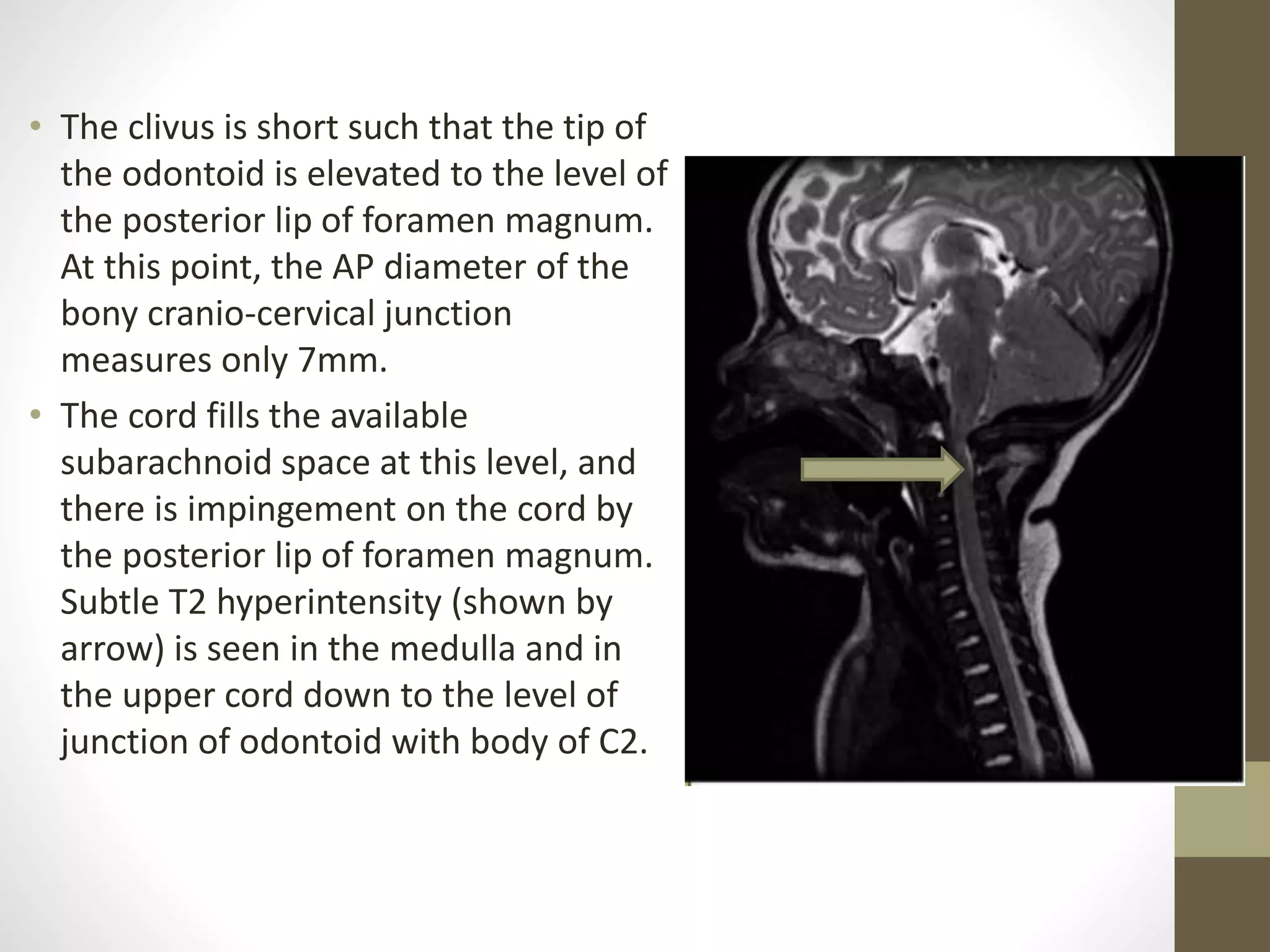 Achondroplasia, pseudochondroplasia & hypochondroplasia | PPTX