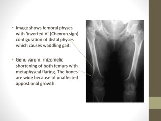 Achondroplasia, pseudochondroplasia & hypochondroplasia | PPTX