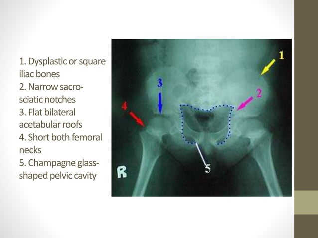Achondroplasia, pseudochondroplasia & hypochondroplasia | PPT