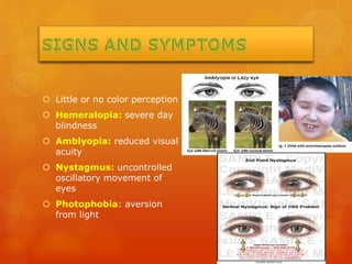 Achromatopsia | PPTX