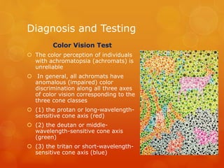 Achromatopsia | PPTX