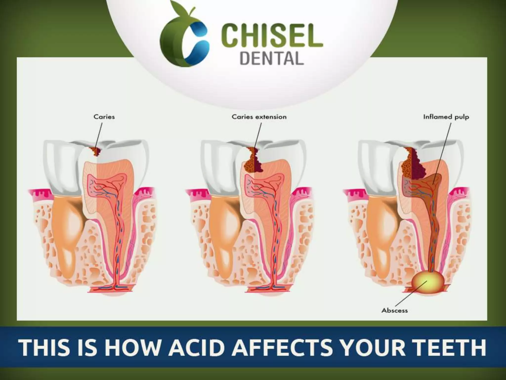 This is How Acid affects your Teeth | PPTX