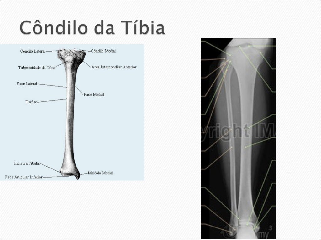 Acidentes Osseos Da Tibia - FDPLEARN