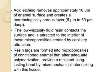 Acid Etching of Enamel and Bond Strength | PPTX