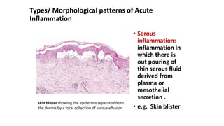 ACUTE INFLAMMATION- CHEMICAL MEDIATORS AND ROLE OF LYMPHATICS AN OVER ...