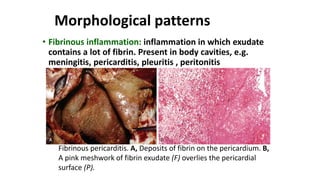 ACUTE INFLAMMATION- CHEMICAL MEDIATORS AND ROLE OF LYMPHATICS AN OVER ...