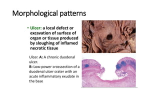 ACUTE INFLAMMATION- CHEMICAL MEDIATORS AND ROLE OF LYMPHATICS AN OVER ...