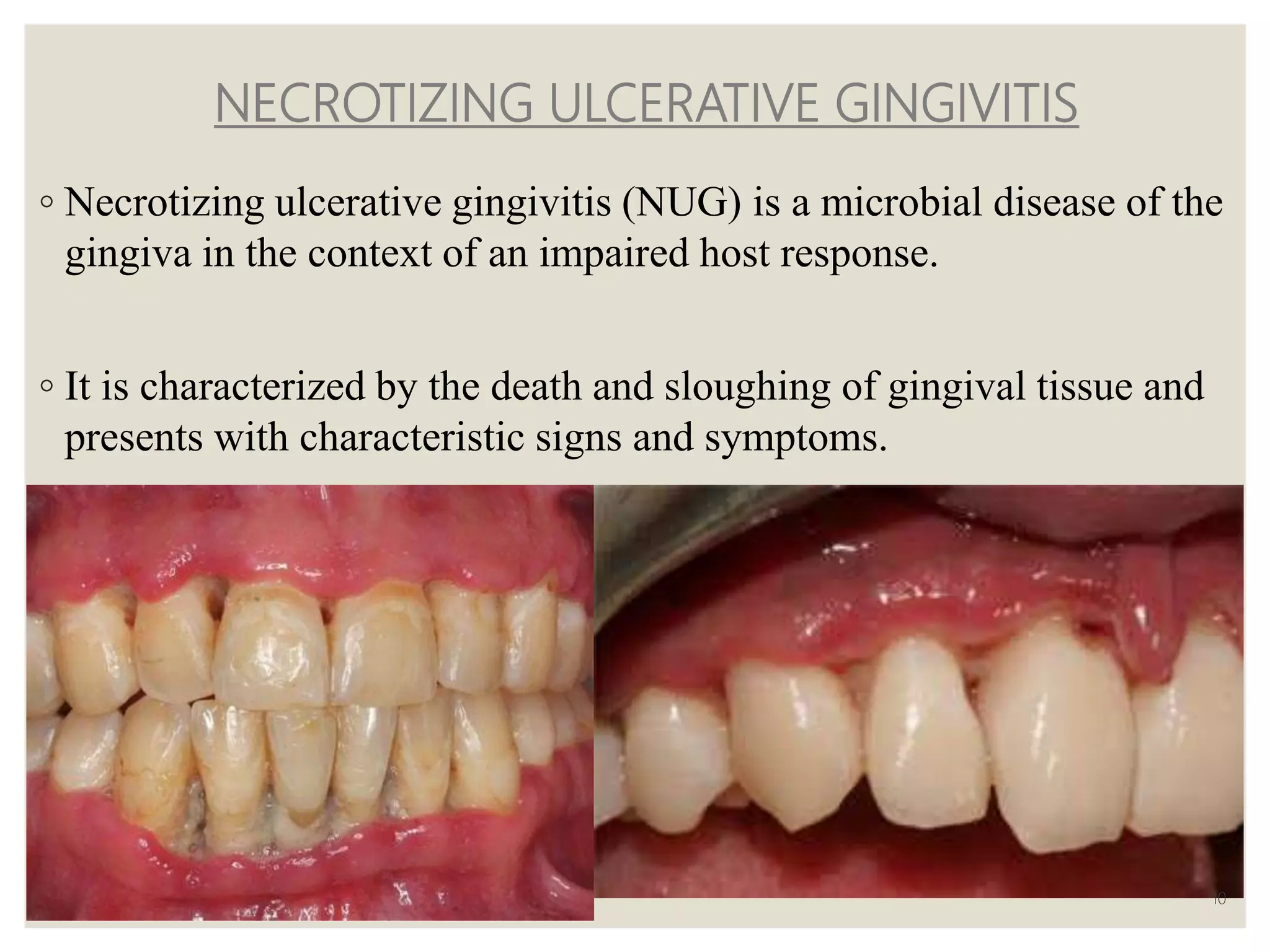 ACUTE GINGIVAL INFECTIONS | PPTX