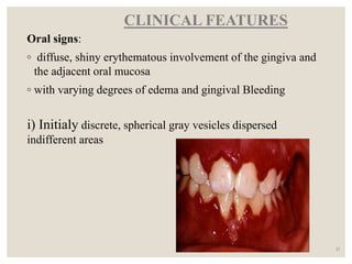 ACUTE GINGIVAL INFECTIONS | PPTX