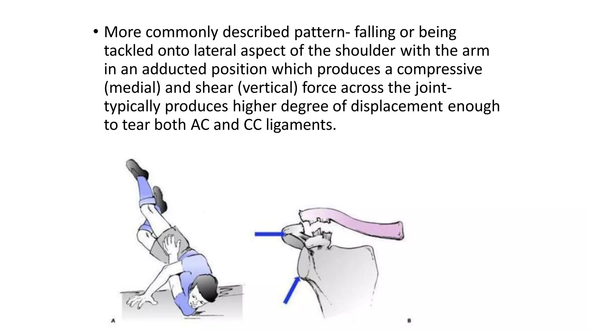 acromioclavicular joint dislocation.pptx