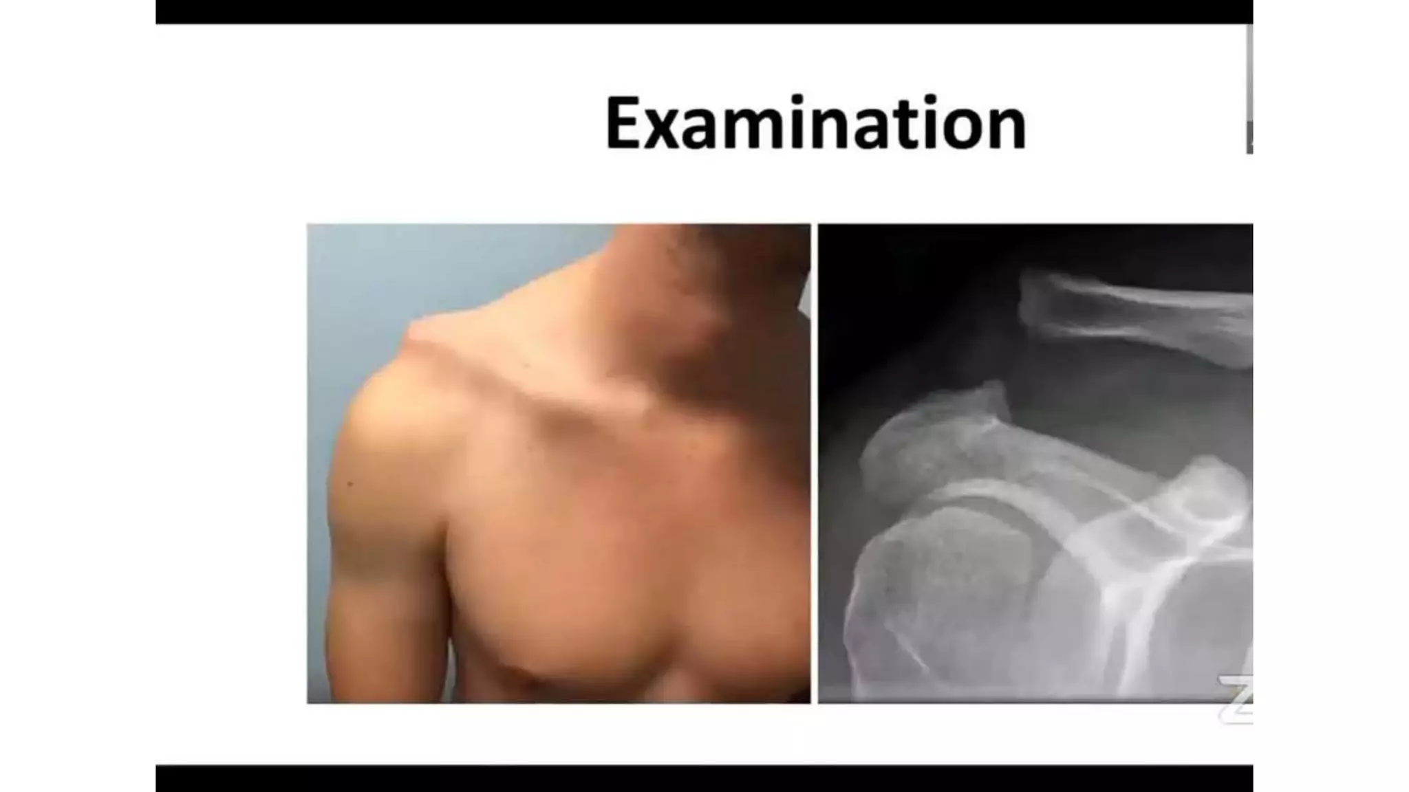 acromioclavicular joint dislocation.pptx