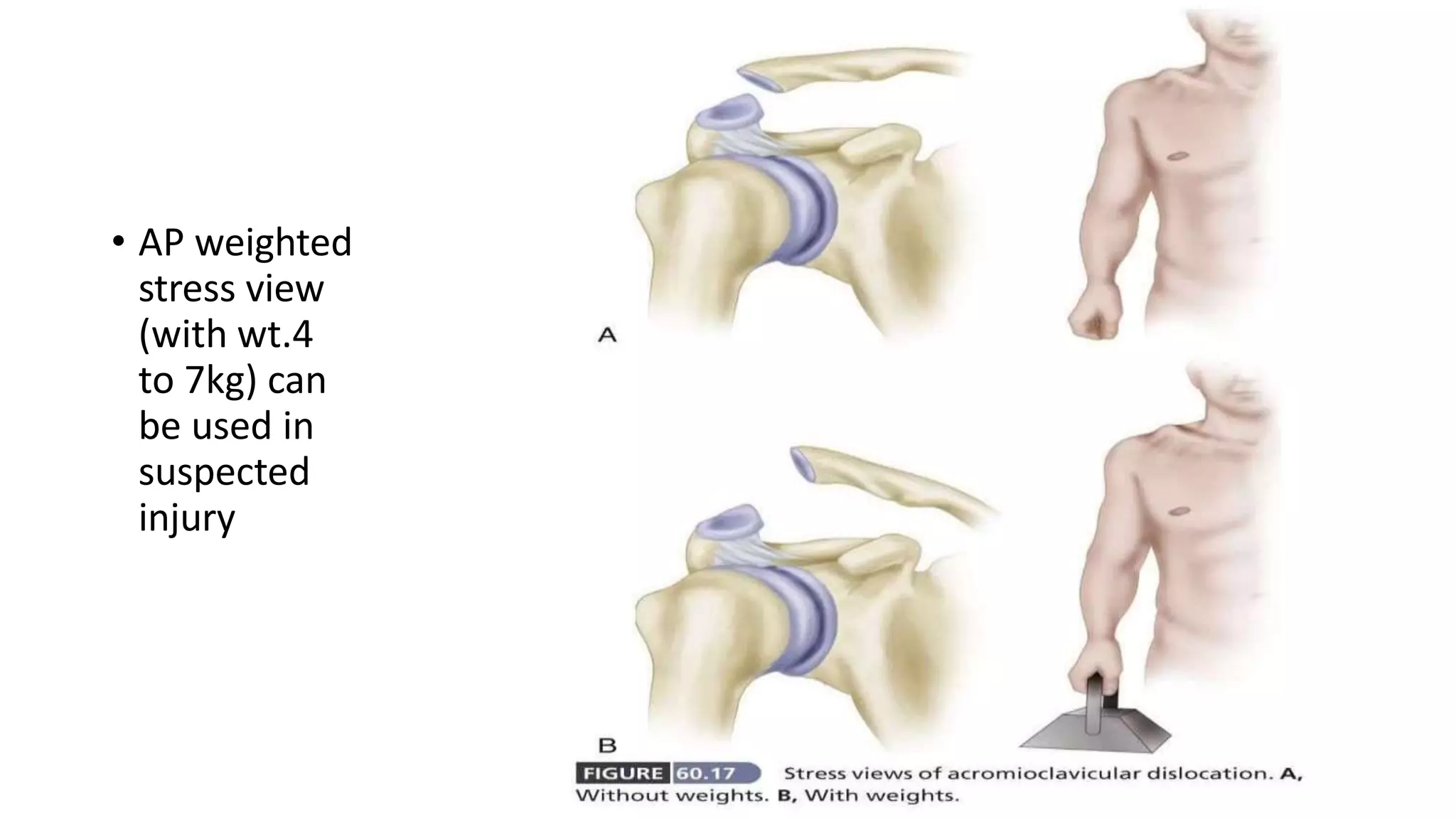 acromioclavicular joint dislocation.pptx