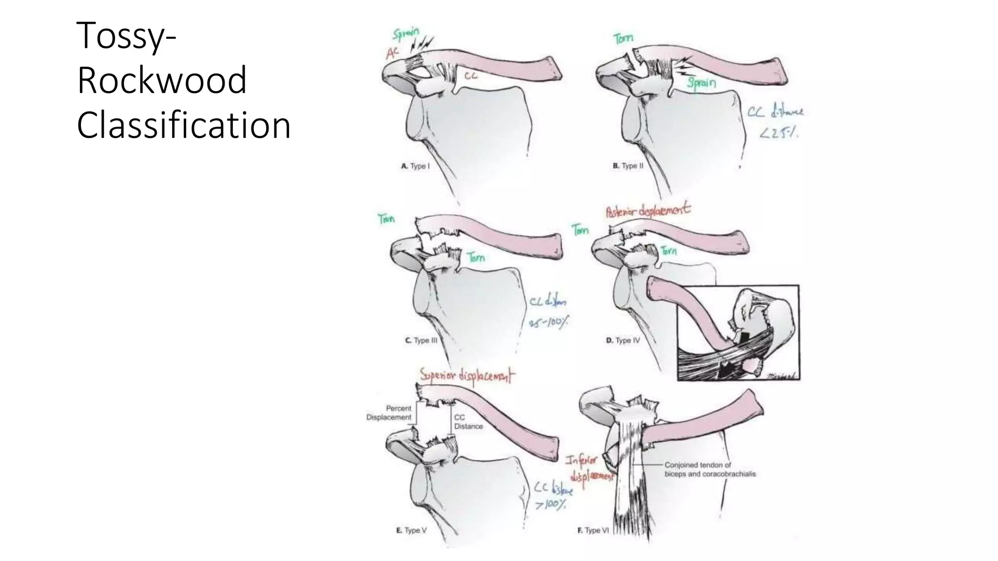 acromioclavicular joint dislocation.pptx