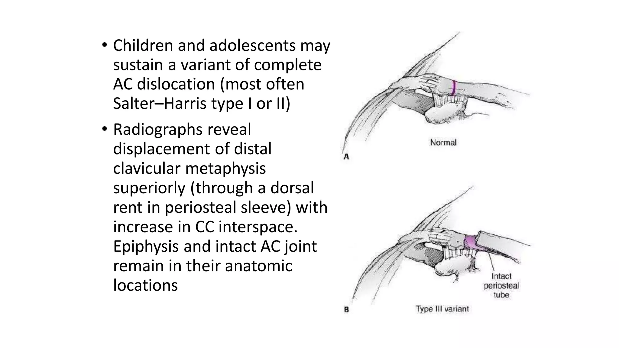 acromioclavicular joint dislocation.pptx | Free Download