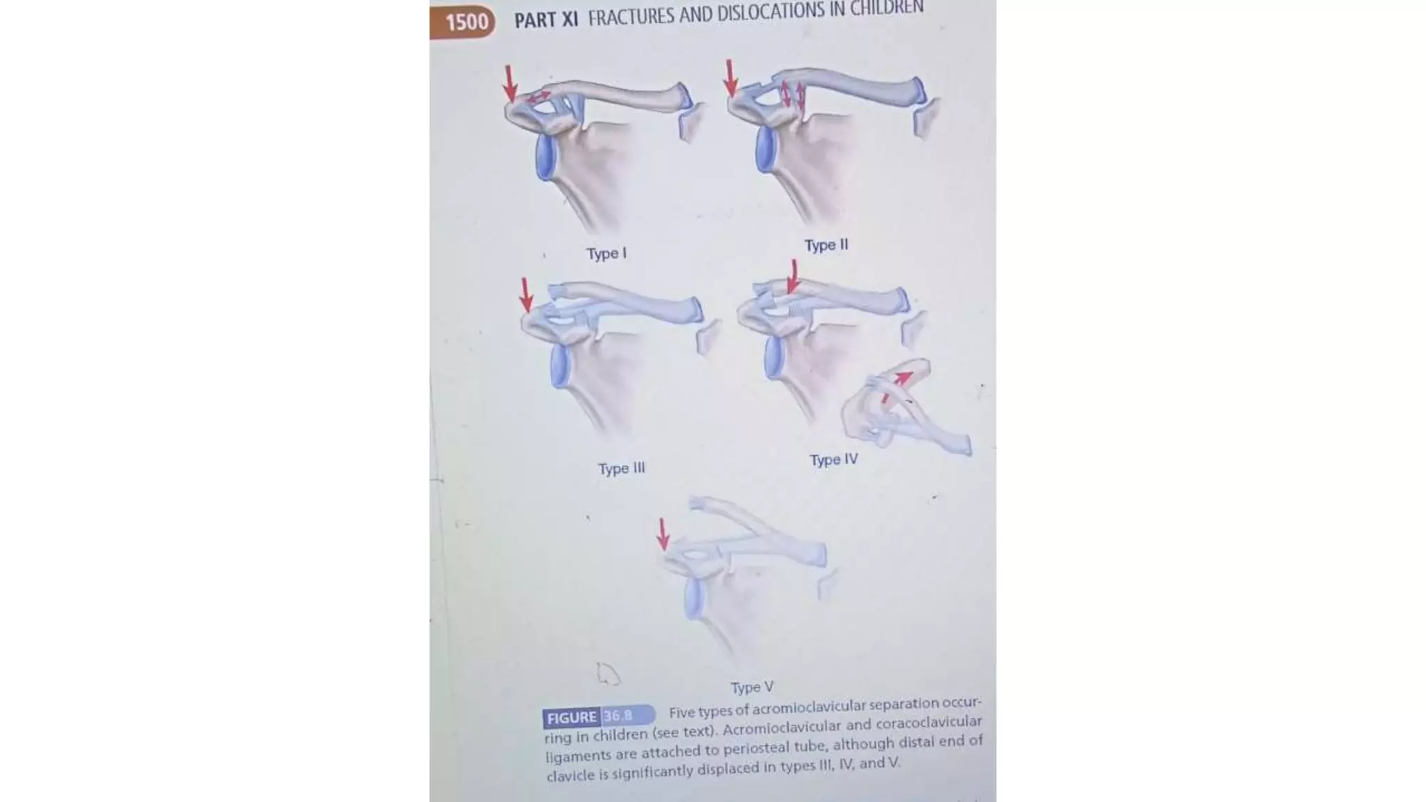 acromioclavicular joint dislocation.pptx