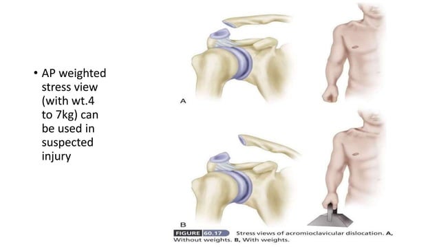 acromioclavicular joint dislocation.pptx
