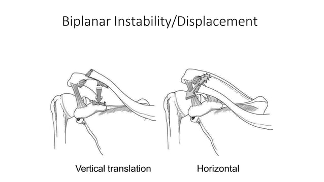 acromioclavicular joint dislocation.pptx