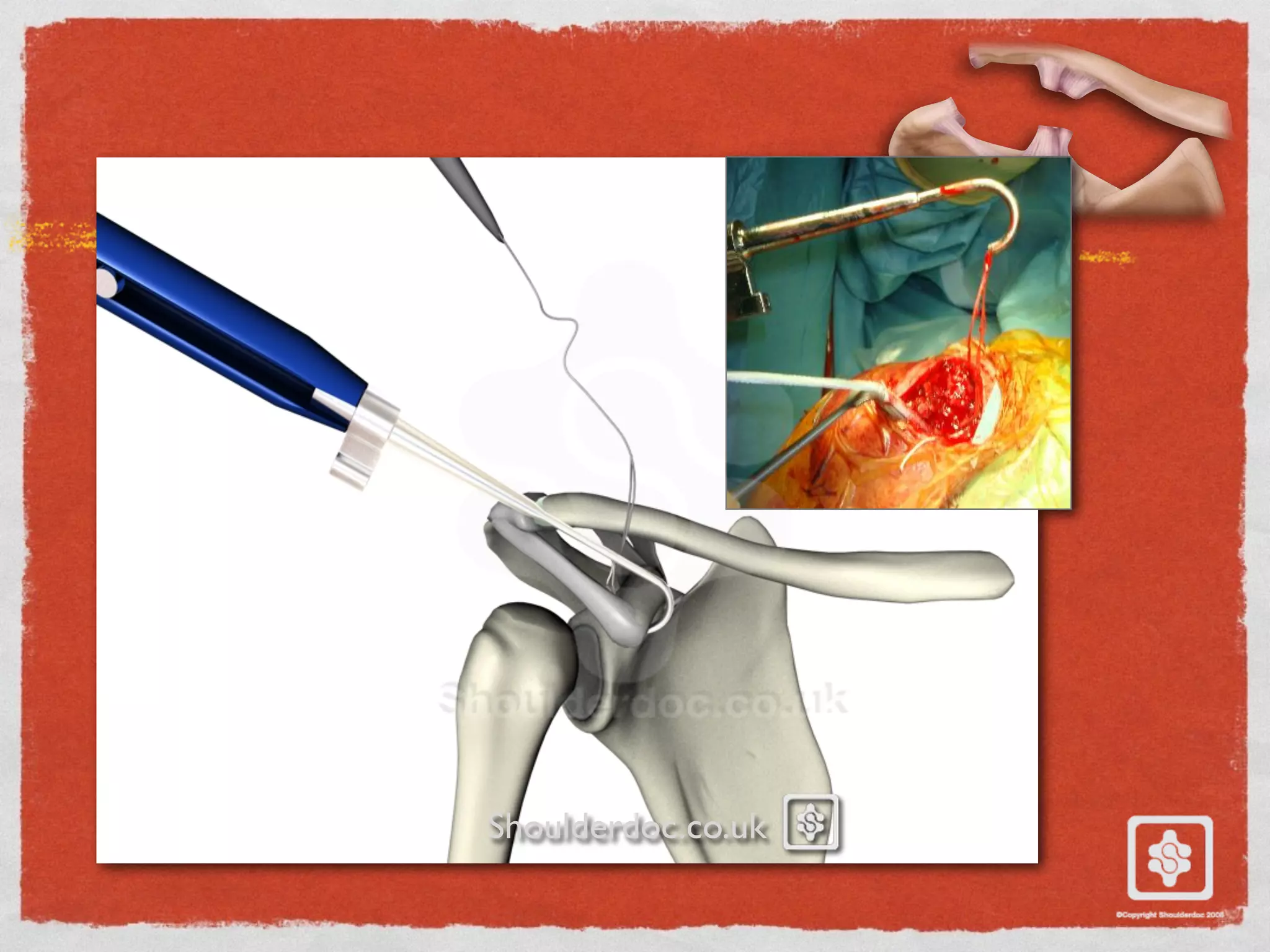 AC Joint dislocation open repair lennard funk | PPT