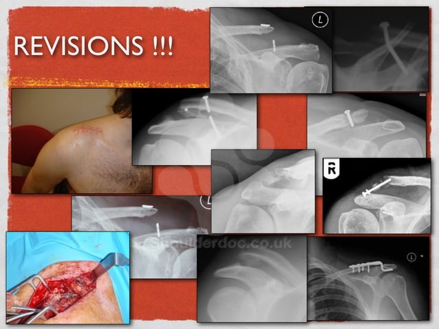 AC Joint dislocation open repair lennard funk | PPT