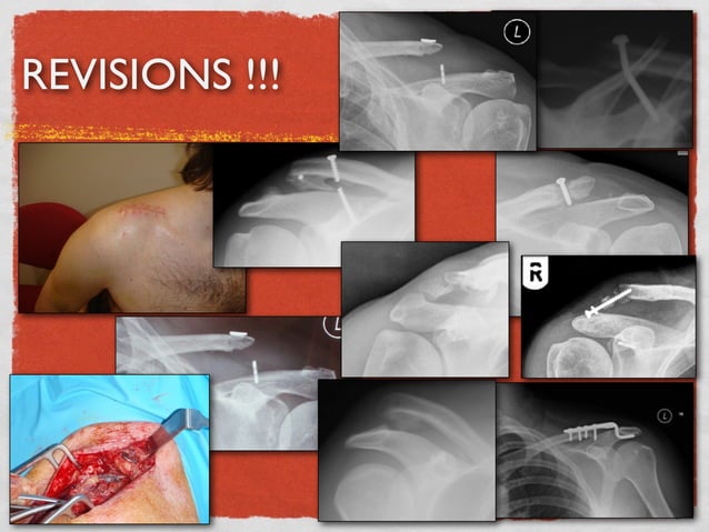 ACJ Disloc Management 2022.pdf