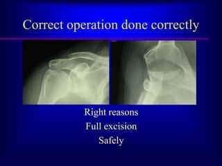 Acj excision watanabe india | PPT