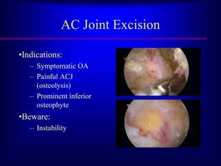 Acj excision watanabe india | PPT