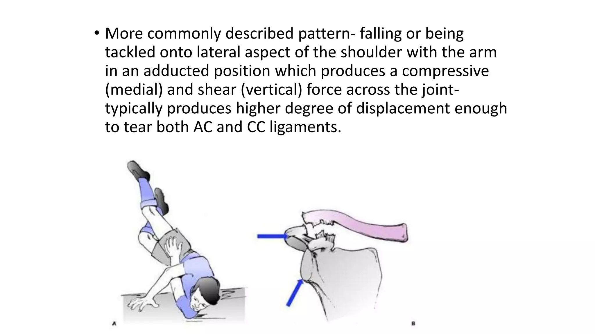 ACROMIOCLAVICULAR JOINT INJURY | PPTX