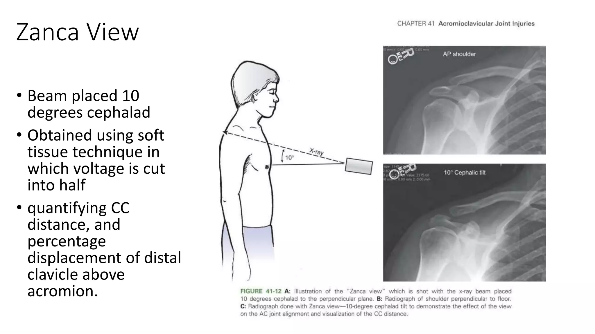 ACROMIOCLAVICULAR JOINT INJURY | PPTX