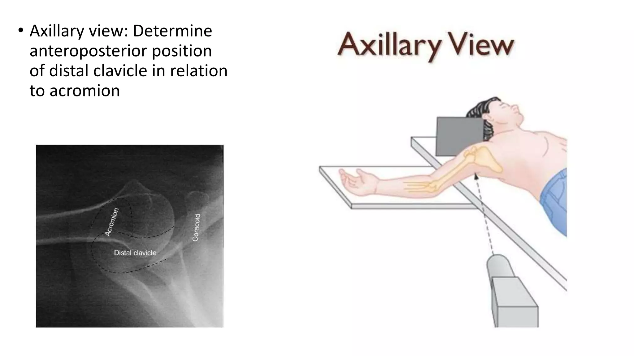 ACROMIOCLAVICULAR JOINT INJURY | PPTX
