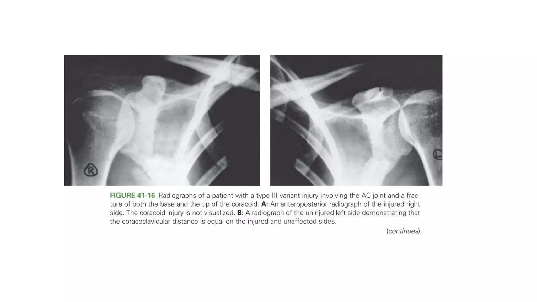 ACROMIOCLAVICULAR JOINT INJURY | PPTX