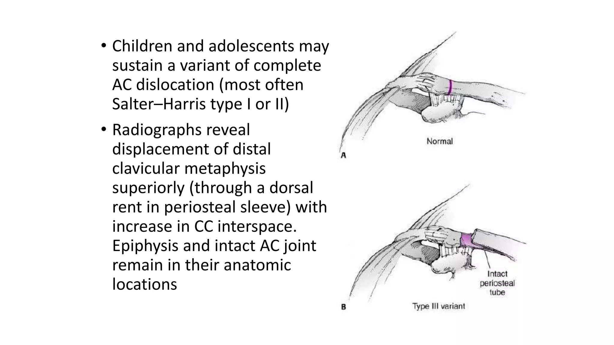 ACROMIOCLAVICULAR JOINT INJURY | PPTX