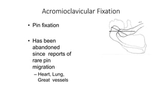 ACROMIOCLAVICULAR JOINT INJURY | PPTX