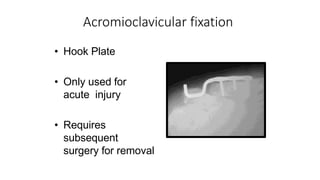 ACROMIOCLAVICULAR JOINT INJURY | PPTX