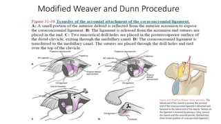 ACROMIOCLAVICULAR JOINT INJURY | PPTX