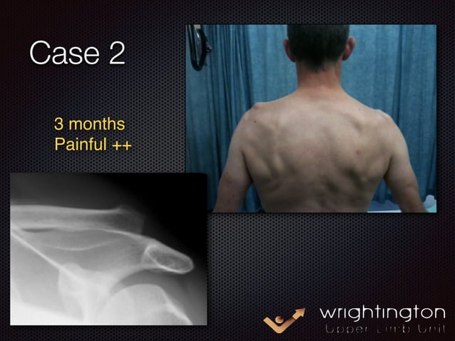 ACJ injury Myths Debunked | PDF | Death, Injury, or Military Conflict | Sensitive Topics