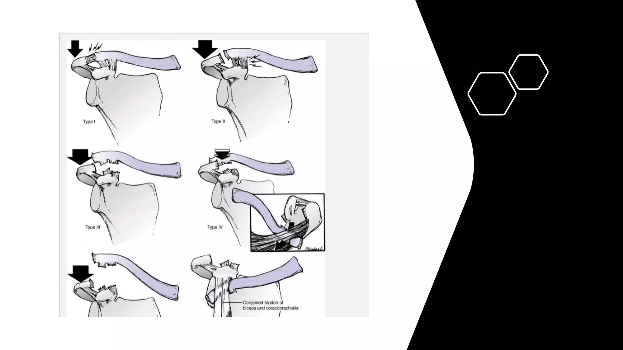 Ac joint dislocation.pptx