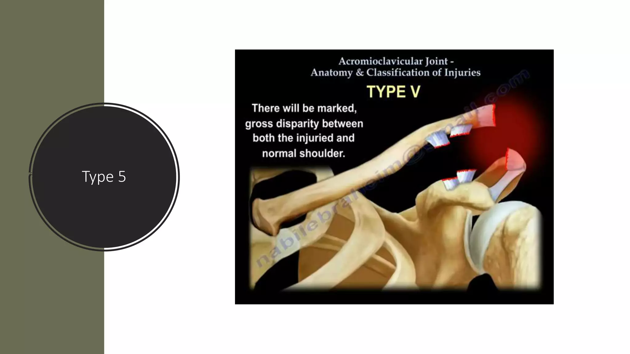 Ac joint dislocation.pptx
