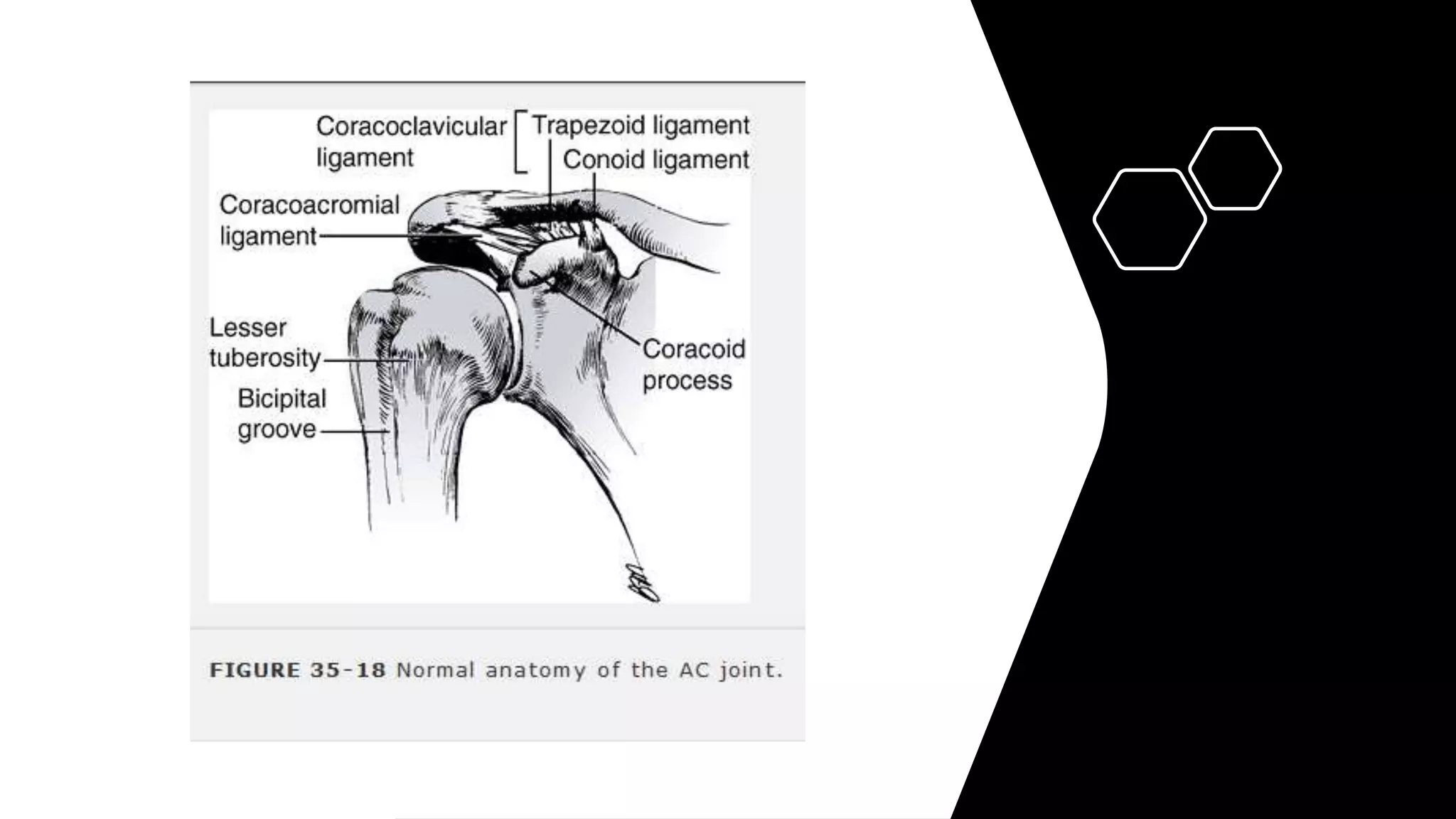 Ac joint dislocation.pptx