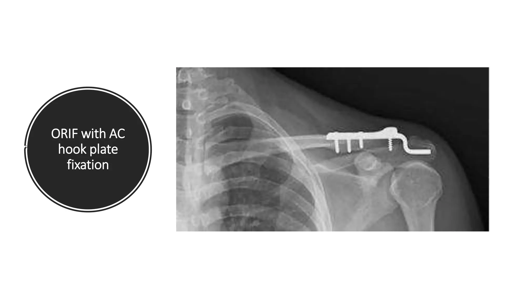 Ac joint dislocation.pptx