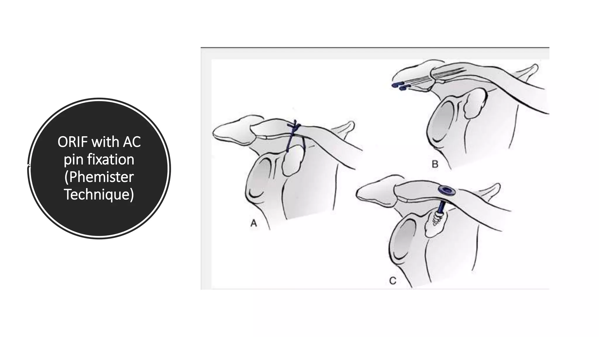 Ac joint dislocation.pptx