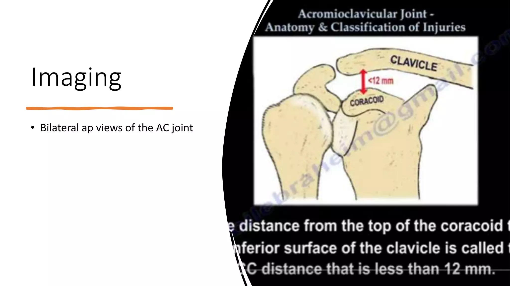 Ac joint dislocation.pptx