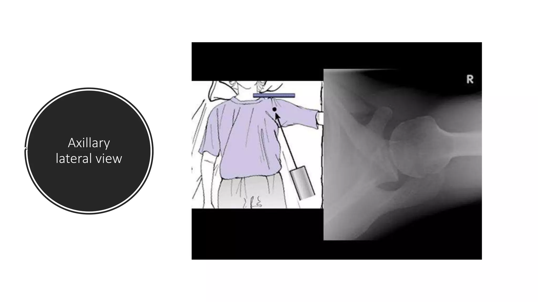 Ac joint dislocation.pptx