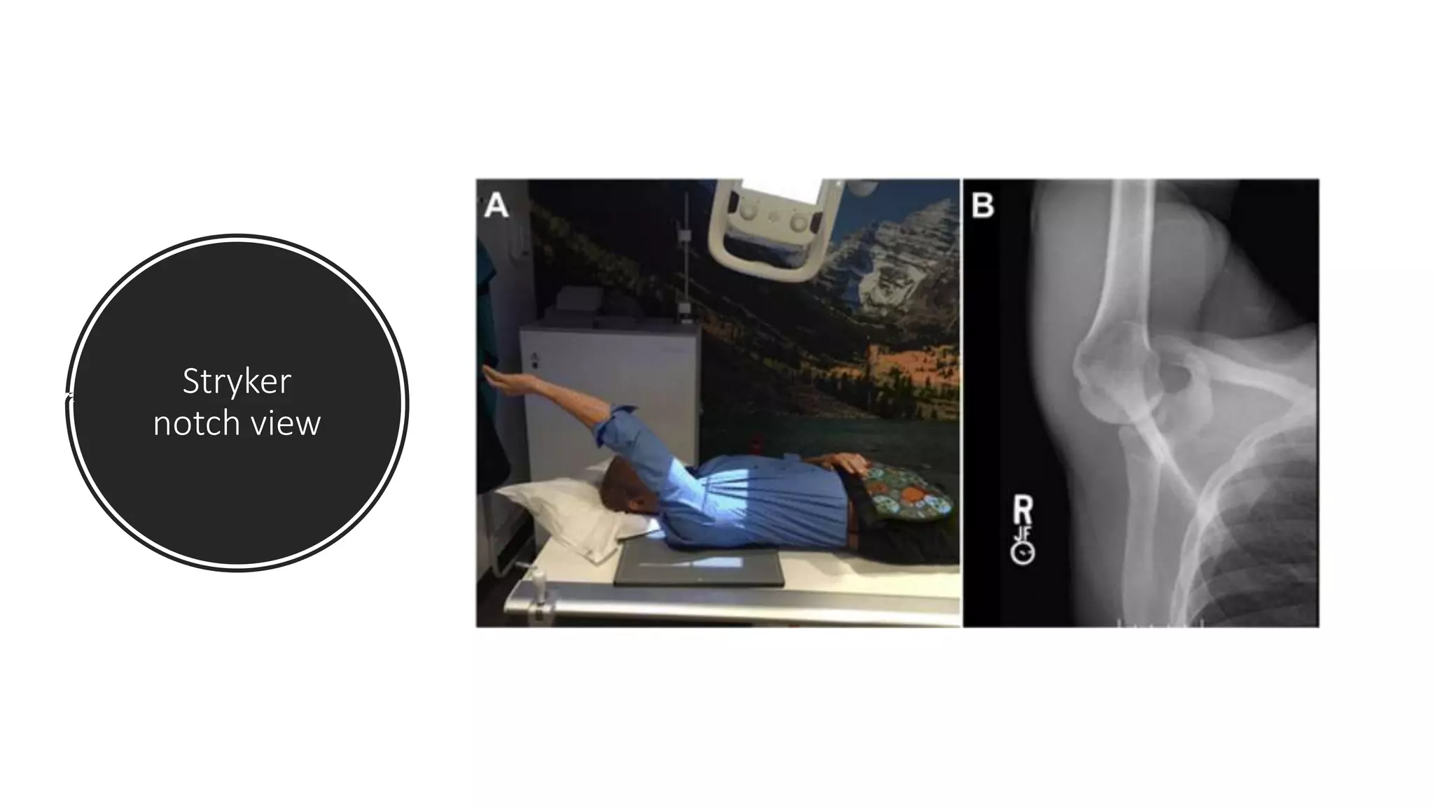 Ac joint dislocation.pptx