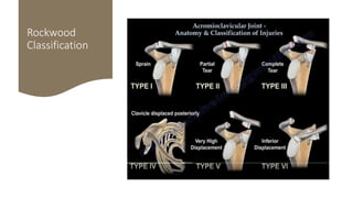 Ac joint dislocation.pptx