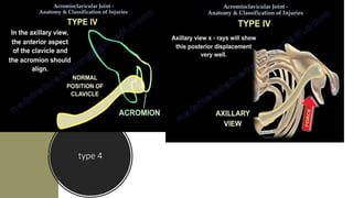 Ac joint dislocation.pptx