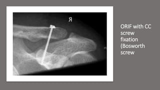 Ac joint dislocation.pptx