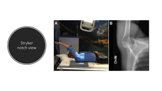 Ac joint dislocation.pptx