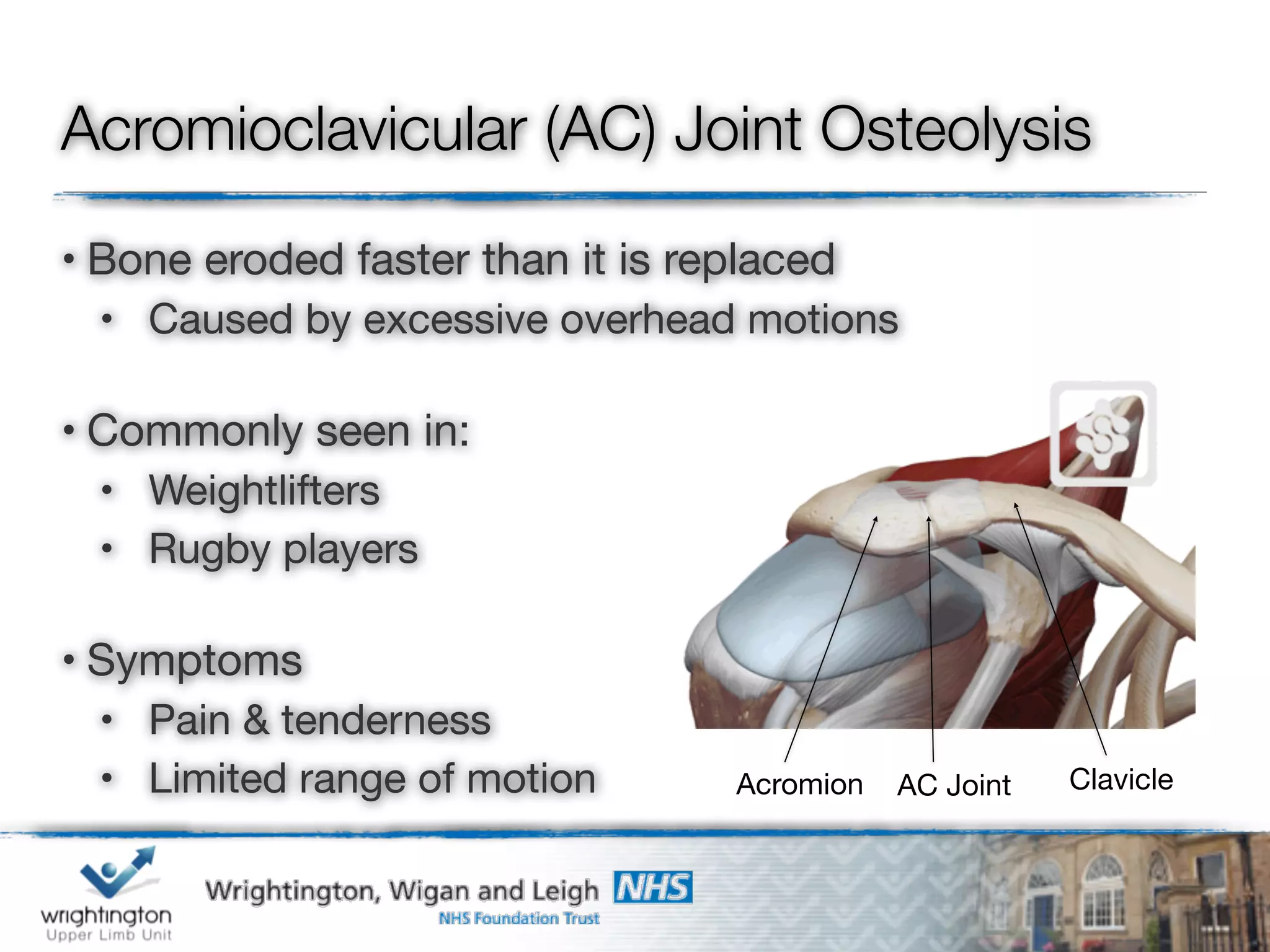 ACJ Osteolysis.pdf