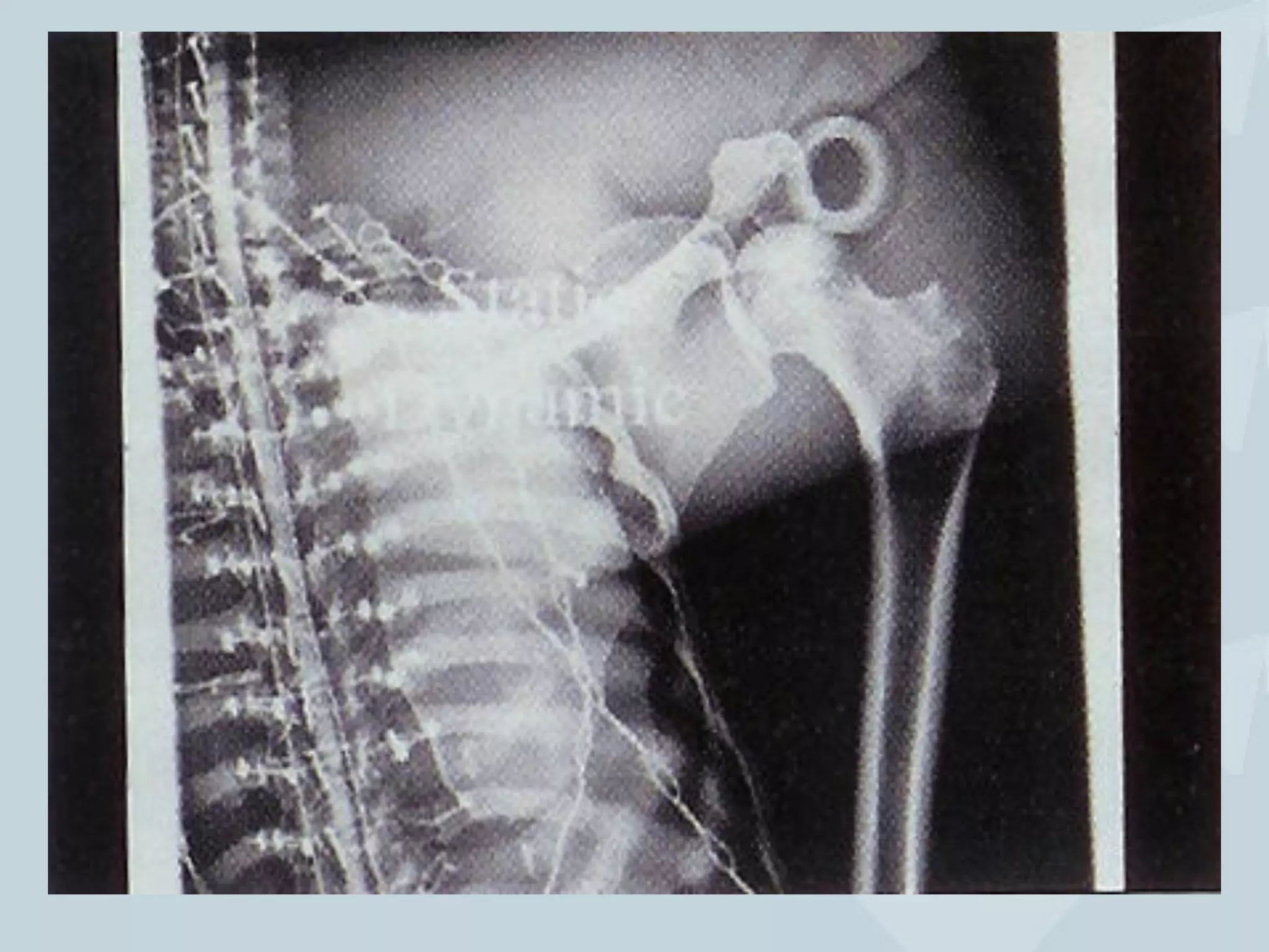 ACJ revision surgery for failed reconstructions and excisions | PDF